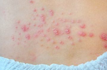 Juicing And Candida: Juice and Smoothie Recipes To Control Candida ...